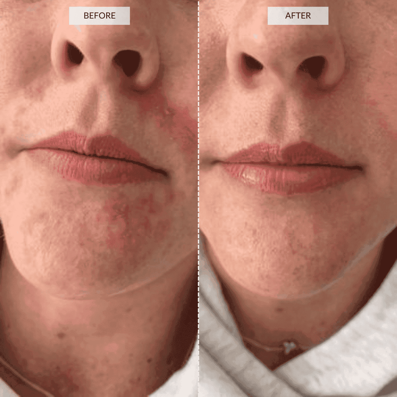 Dermalux Flex MD LED Light Therapy Device | CurrentBody USA