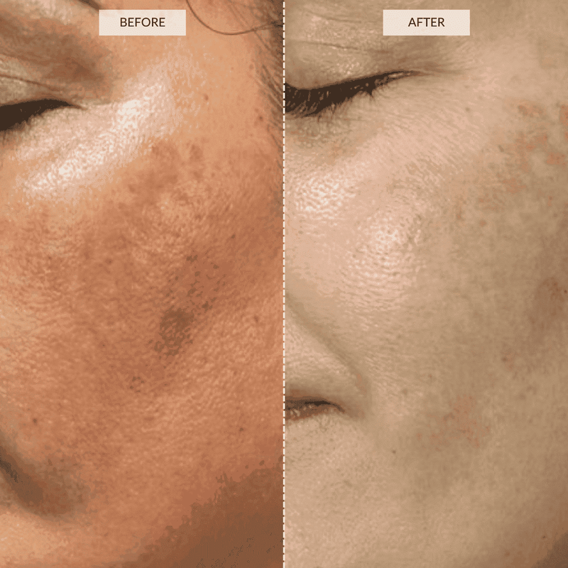 Dermalux Flex MD LED Light Therapy Device | CurrentBody USA