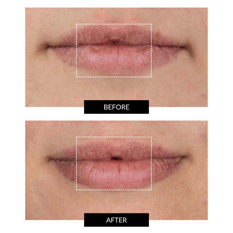 CurrentBody Skin LED Lip Perfector | CurrentBody USA