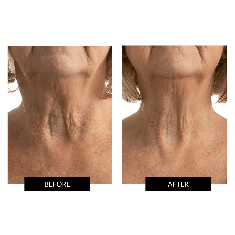LED Neck and Dec Perfector | Chest Wrinkle Treatment | CurrentBody USA