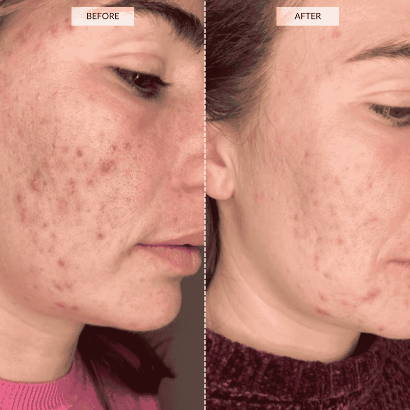 Dermalux Flex MD LED Light Therapy Device | CurrentBody USA